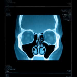 Aneurysm Clipping Dallas TX - Brain Aneurysm Fort Worth TX