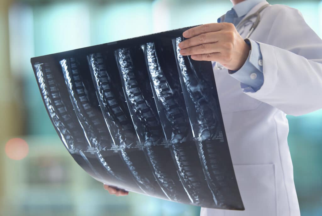 Intradural Spinal Cord Tumor Resection Dallas & Fort Worth